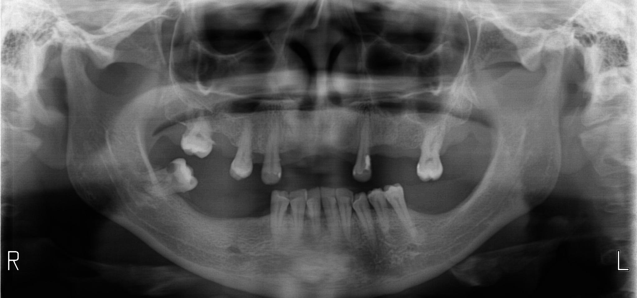 Cavity Object Detection Dataset By Xperts