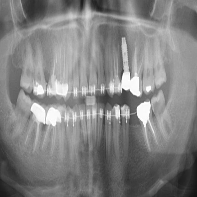 dental_project Instance Segmentation Dataset by dental project