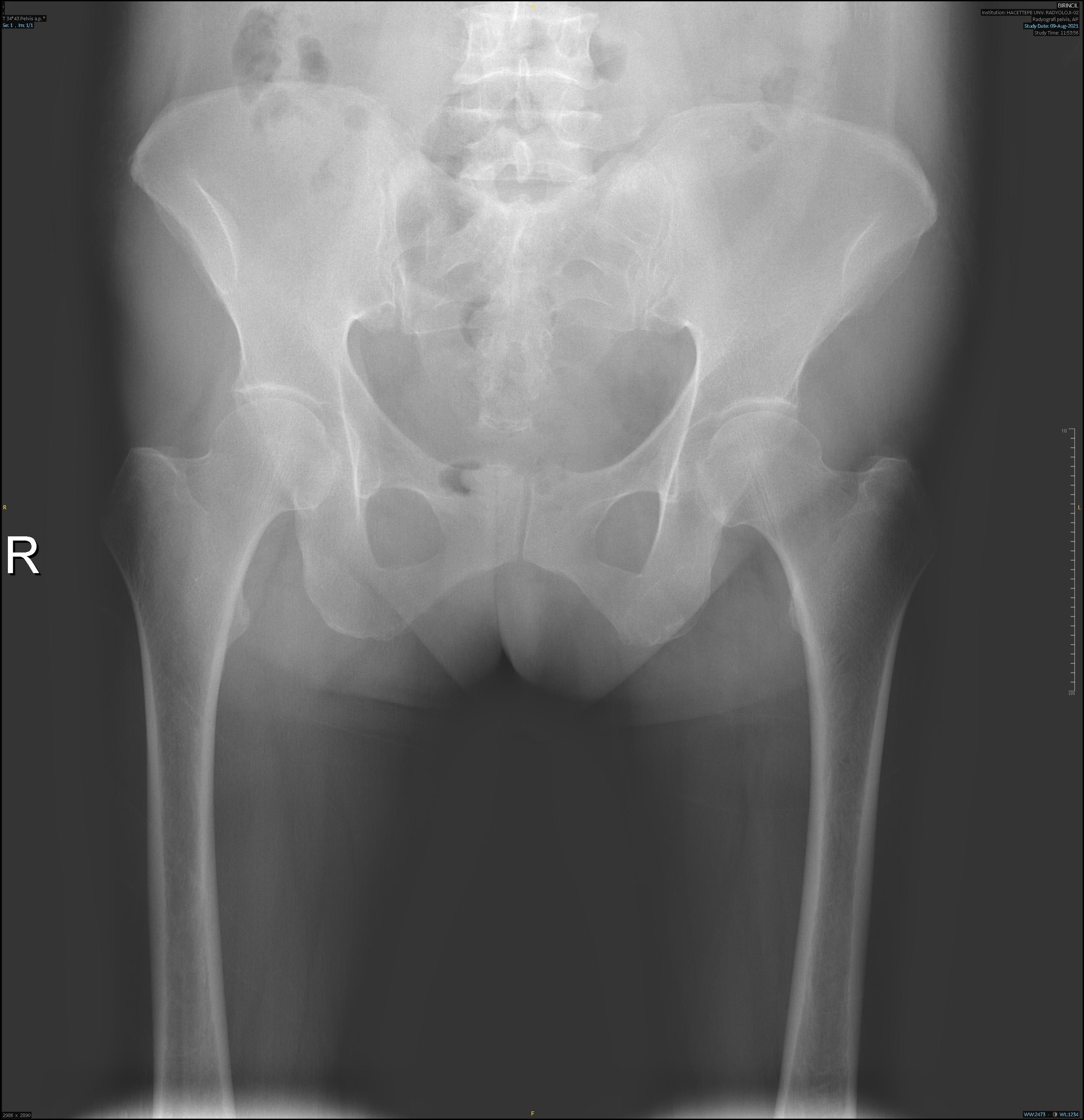 Proximal Femur Detection And Cla Instance Segmentation Dataset V1 Test 640 By Thesisyolo V8