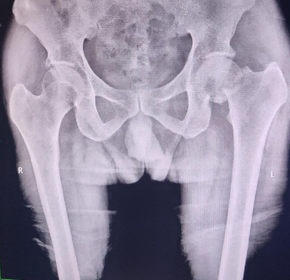 Proximal Femur Fractures Instance Segmentation Dataset and Pre-Trained Model by ThesisYolo v8