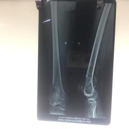 Bone Tumor Image Segmentation Object Detection Dataset by RaZereN