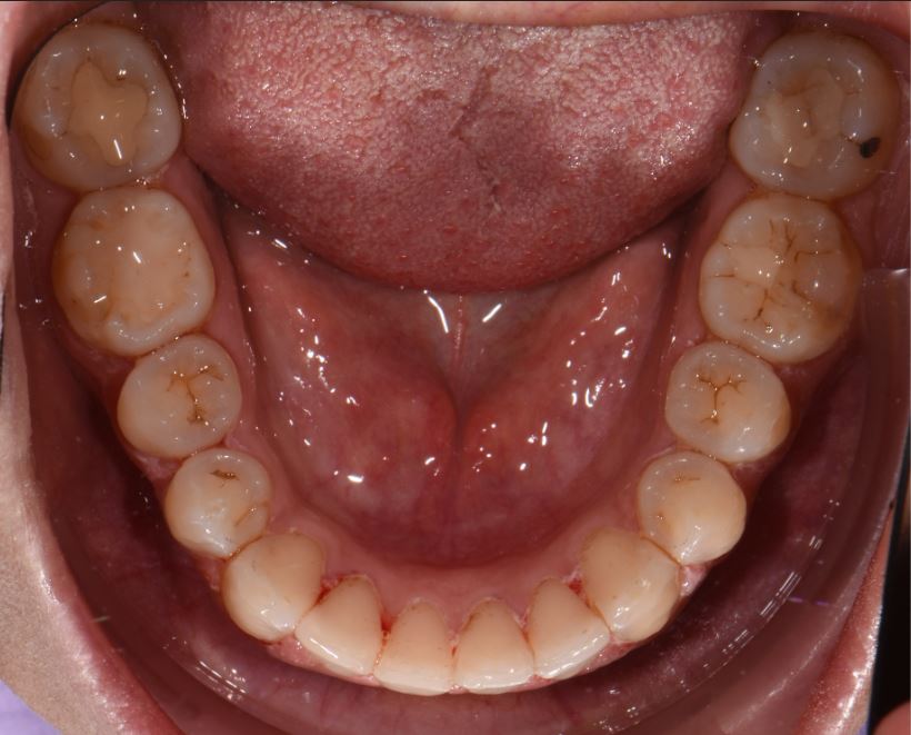 Dental Dataset Level3 Object Detection Dataset V3 2024 10 13 8 08am