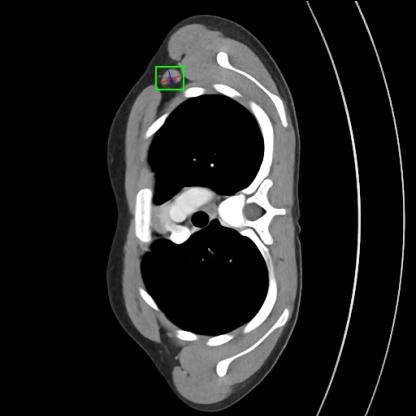 lung_cancer Object Detection Model by Kero Ashraf
