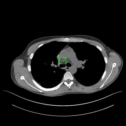 lung-segmentation Object Detection Dataset by Kero Ashraf