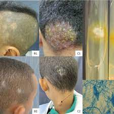 skin disease identification Object Detection Dataset by yolov5