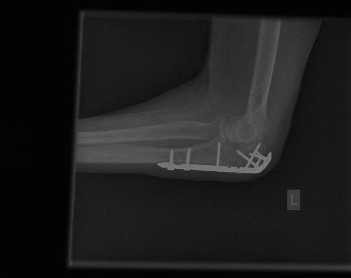 bone-fracture-detection Object Detection Model by daanyalnoorfarrukh