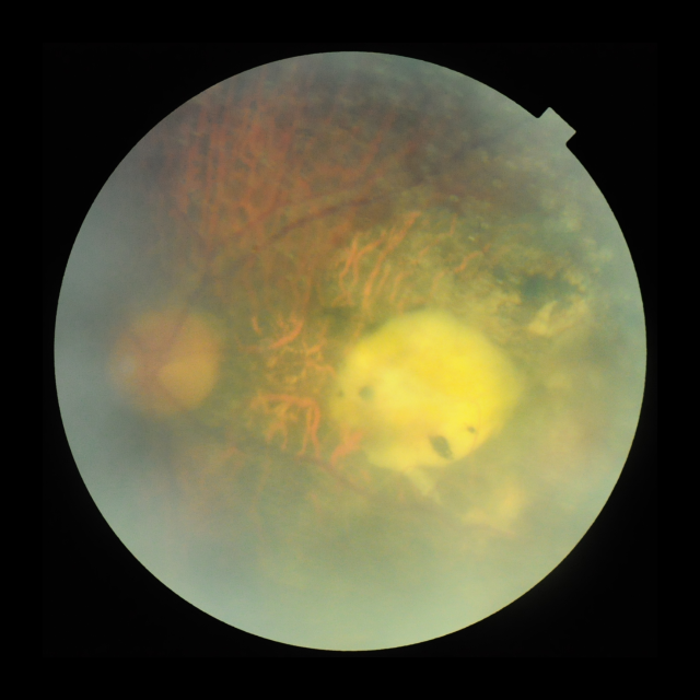 AMD classification Classification Model by Maathew