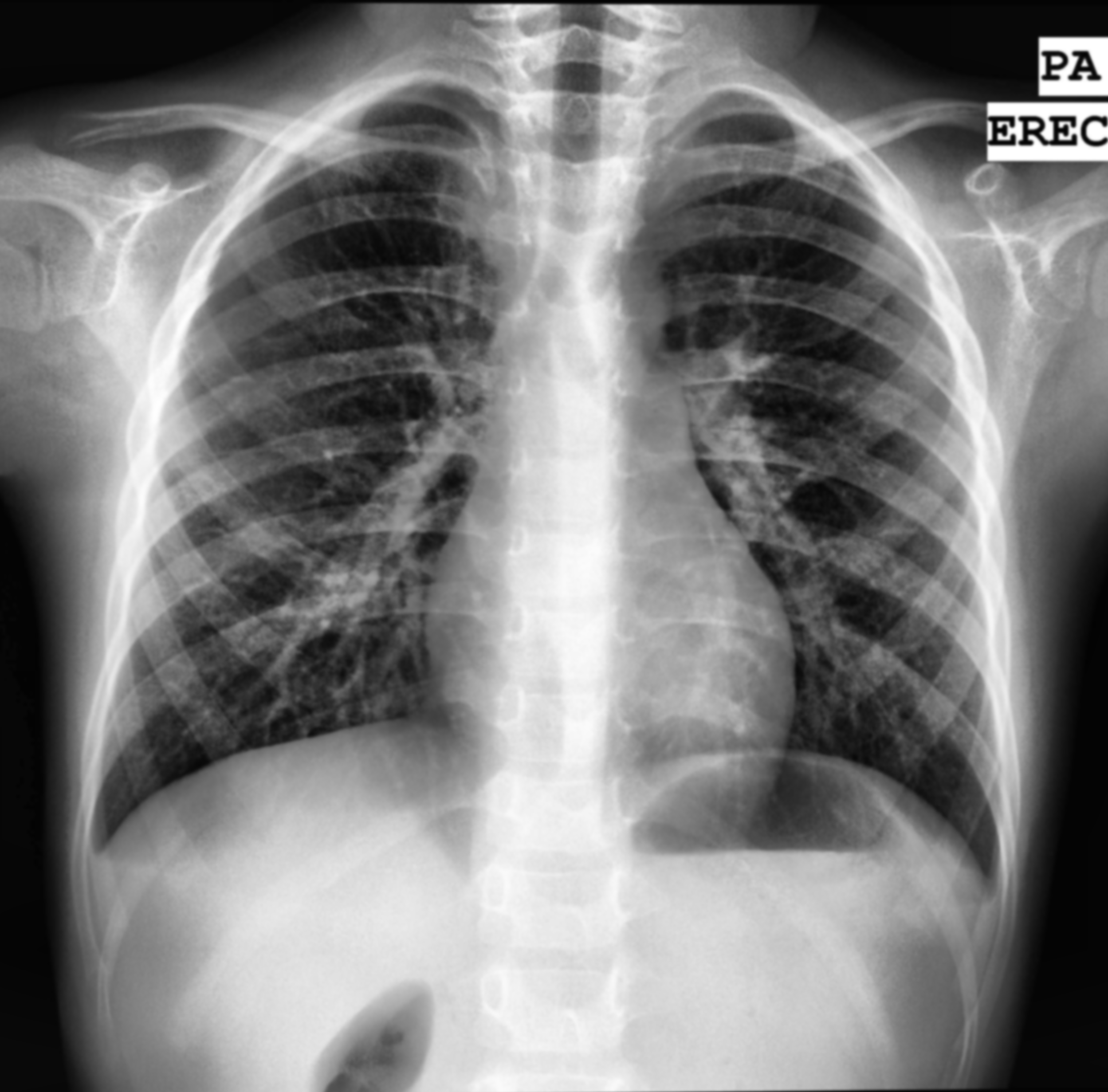 unet-segmentation Object Detection Dataset by Segmentation CXR
