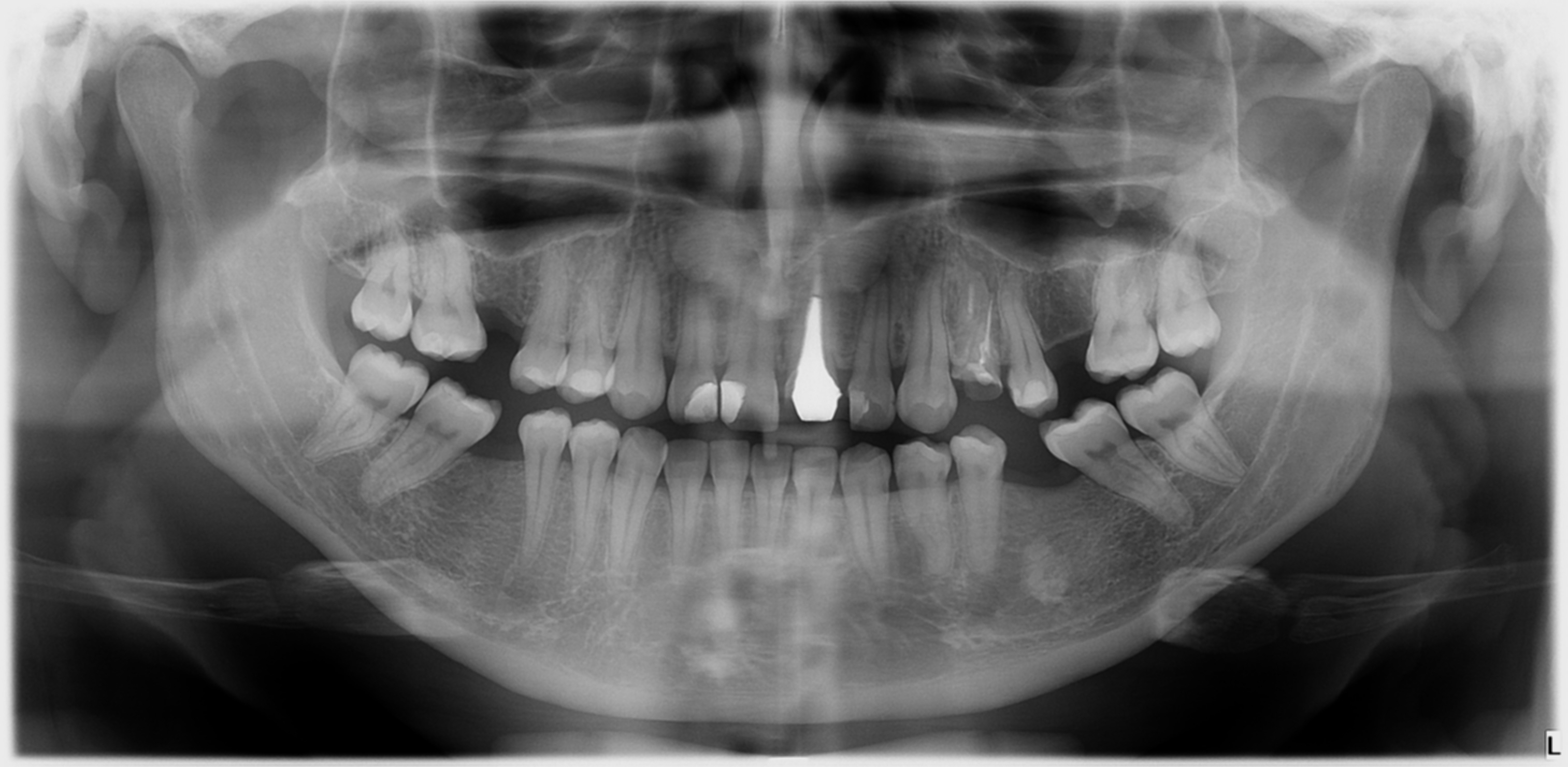 Canal Mandibular Object Detection Dataset And Pre Trained Model By