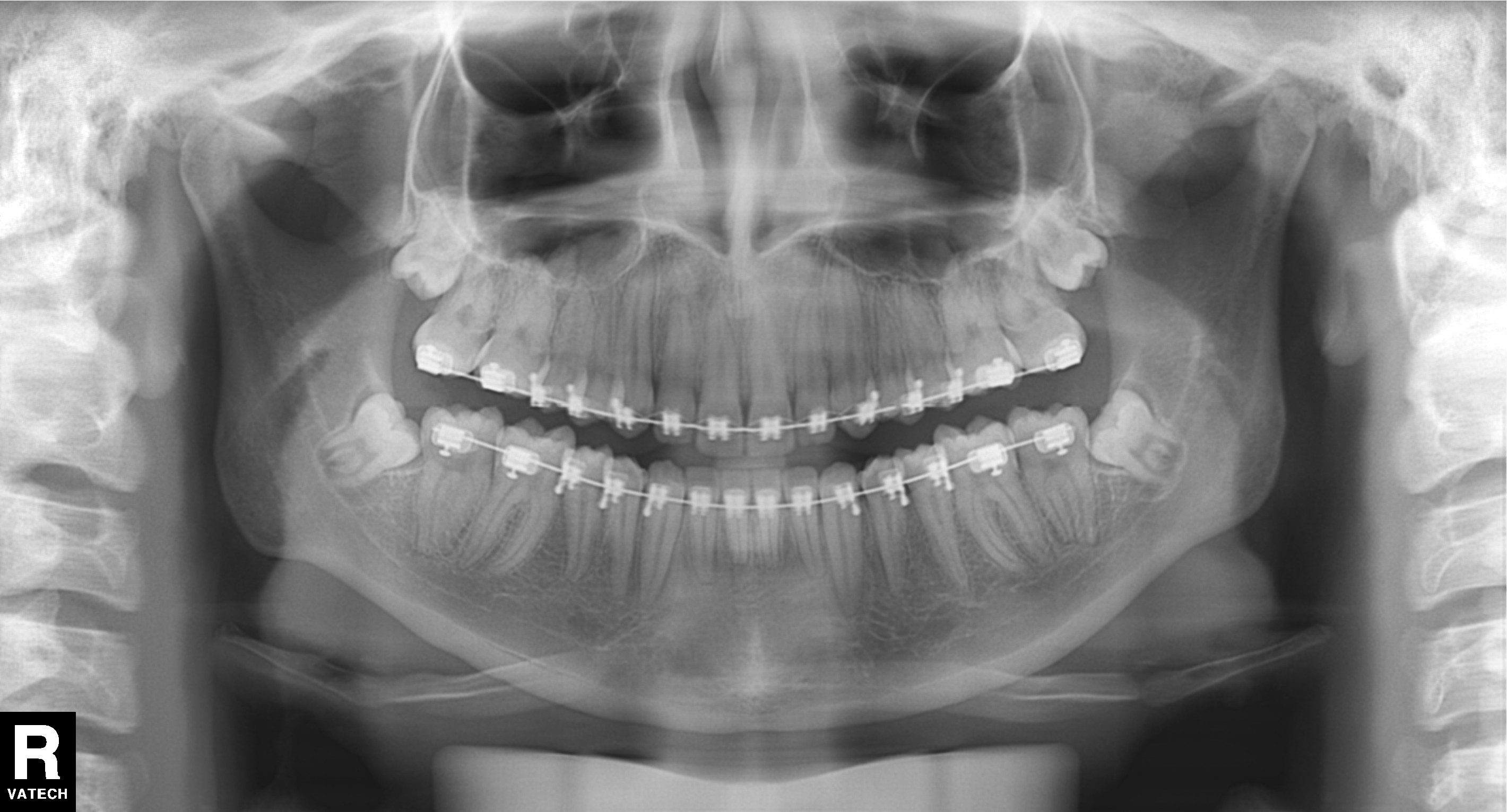 Canal Mandibular Object Detection Dataset By Iniciao Cientfica