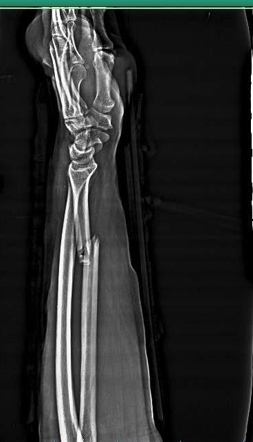 bone fracture Object Detection Model by unit