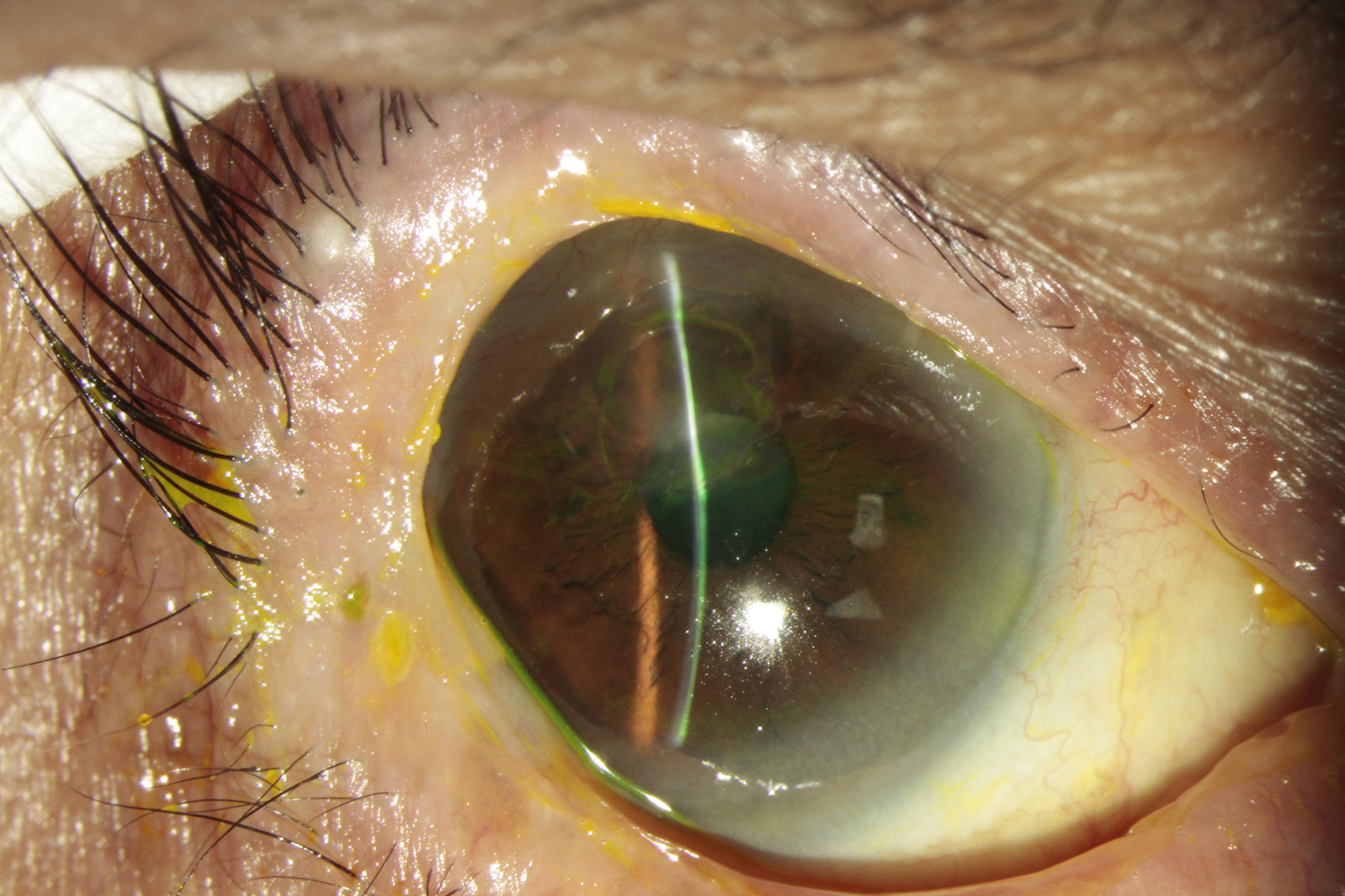 Keratitis Instance Segmentation Dataset by YICHEN