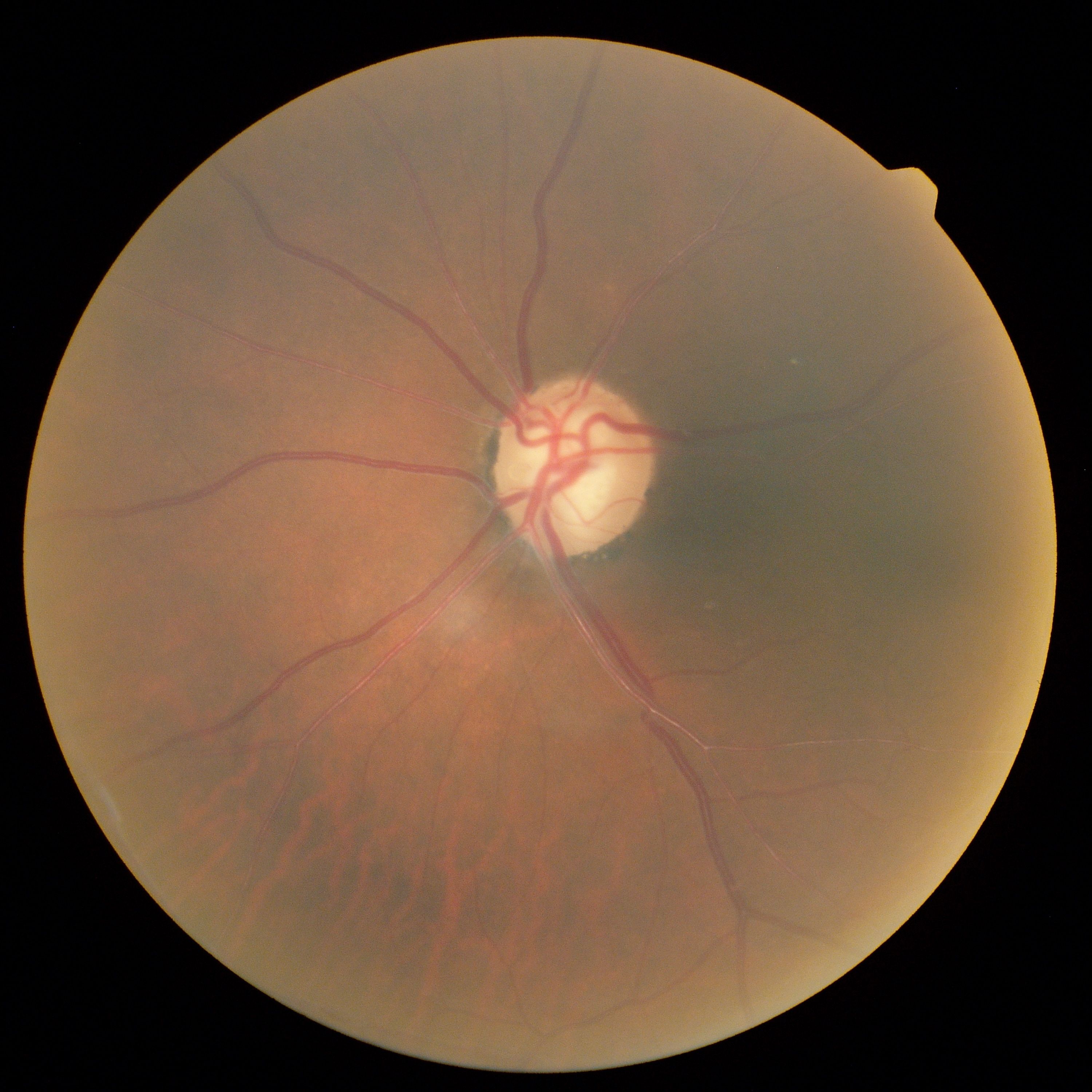 glaucoma detection Classification Dataset and Pre-Trained Model by data ...