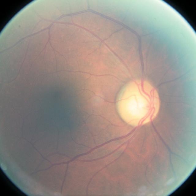 eye diseases (eye-diseases-bbcmb) - Roboflow Universe