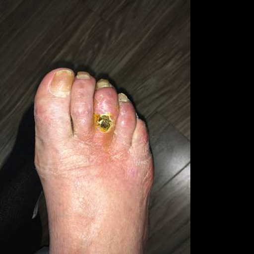 Instance segmentation using yolo v8 of foot ulcer (instance-segmentation-using-yolo-v8-of-foot ...