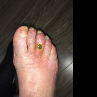 Instance segmentation using yolo v8 of foot ulcer (instance-segmentation-using-yolo-v8-of-foot ...