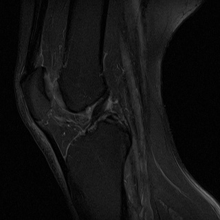 detectron2 acl detection Object Detection Model by Semantic Segmentation