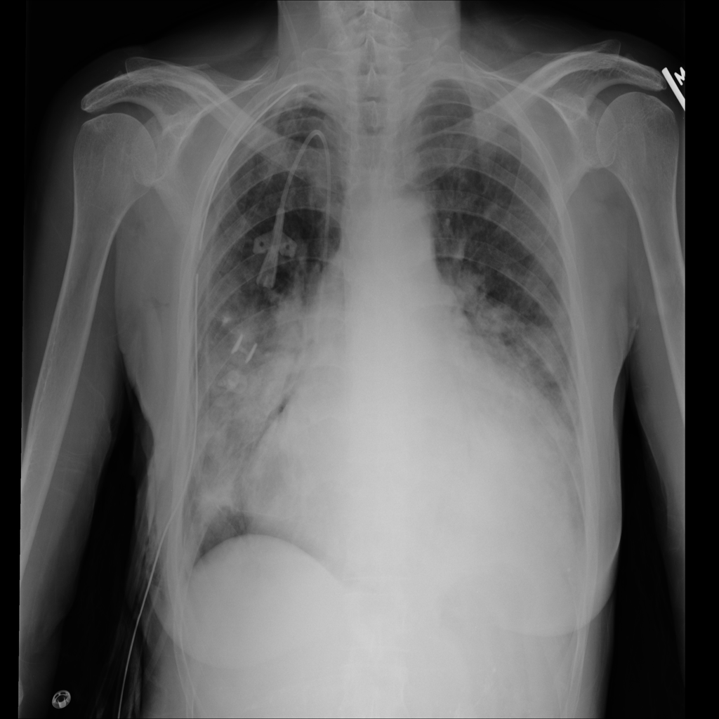 chest x ray images Object Detection Model by Willy