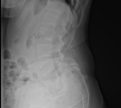 Lumbar Spine Instance Segmentation Dataset by RP Team