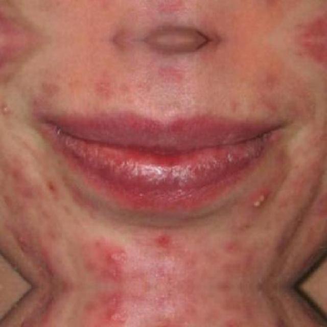 acne instnce Instance Segmentation Model by Acne