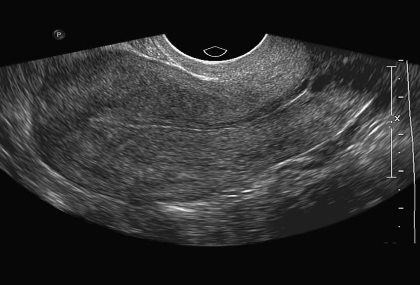 PCOS Classification Model by PCOS