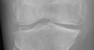 Knee Object Detection Object Detection Dataset By Yolov11