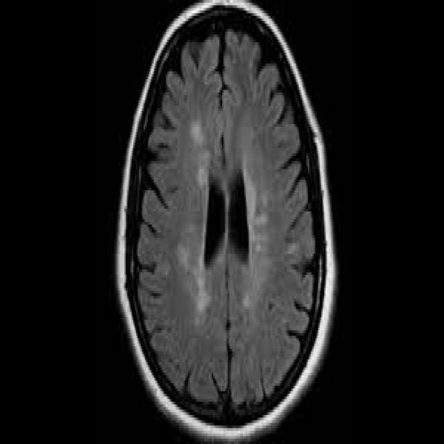 Detecting Tumor Object Detection Dataset By Fbcew