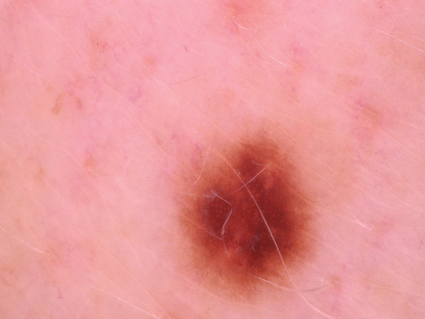 HAM10000 Instance Segmentation Instance Segmentation Dataset by EPICS ...