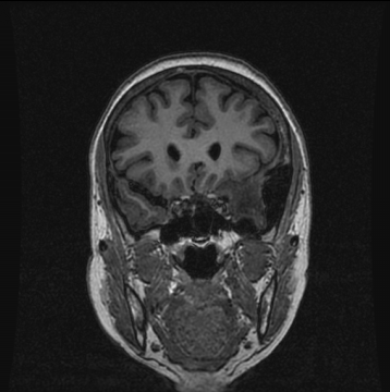 MRI Brain Instance Segmentation Dataset by Dea Ayu