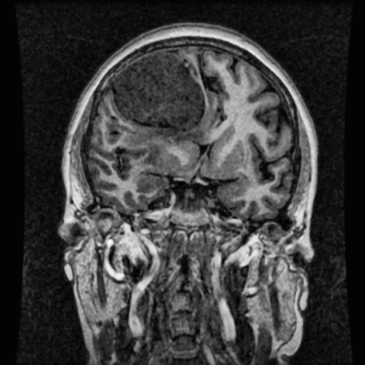 MRI-BRAVO Instance Segmentation Dataset by Dea Ayu