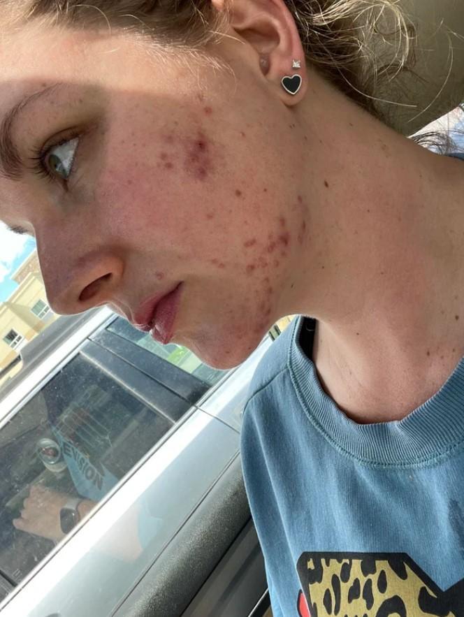 Spots Object Detection Model (v2, 2023-06-19 10:45am) by WORK acne