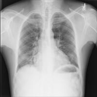 nih-xray-fsod-sbyy Object Detection Dataset by Roboflow100VL FSOD