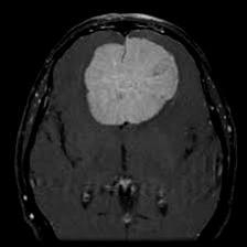 crystal-clean-brain-tumors-mri-dataset-ysuvi-fsod-inmj Object Detection ...