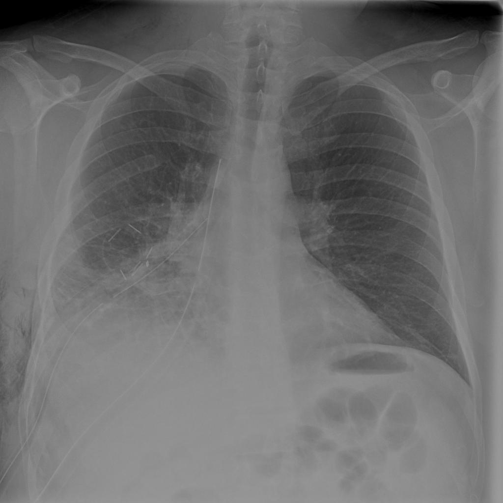 Nih Xray Fsod Sbyy Object Detection Dataset By Roboflow100vl Fsod