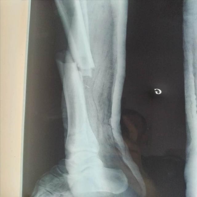 Bone-Fracture Object Detection Model by shofiagh