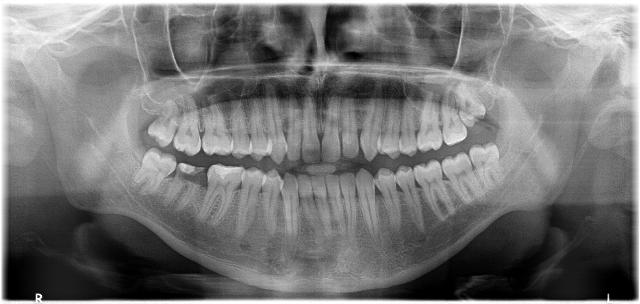 Teeth Instance Segmentation Model by Fire