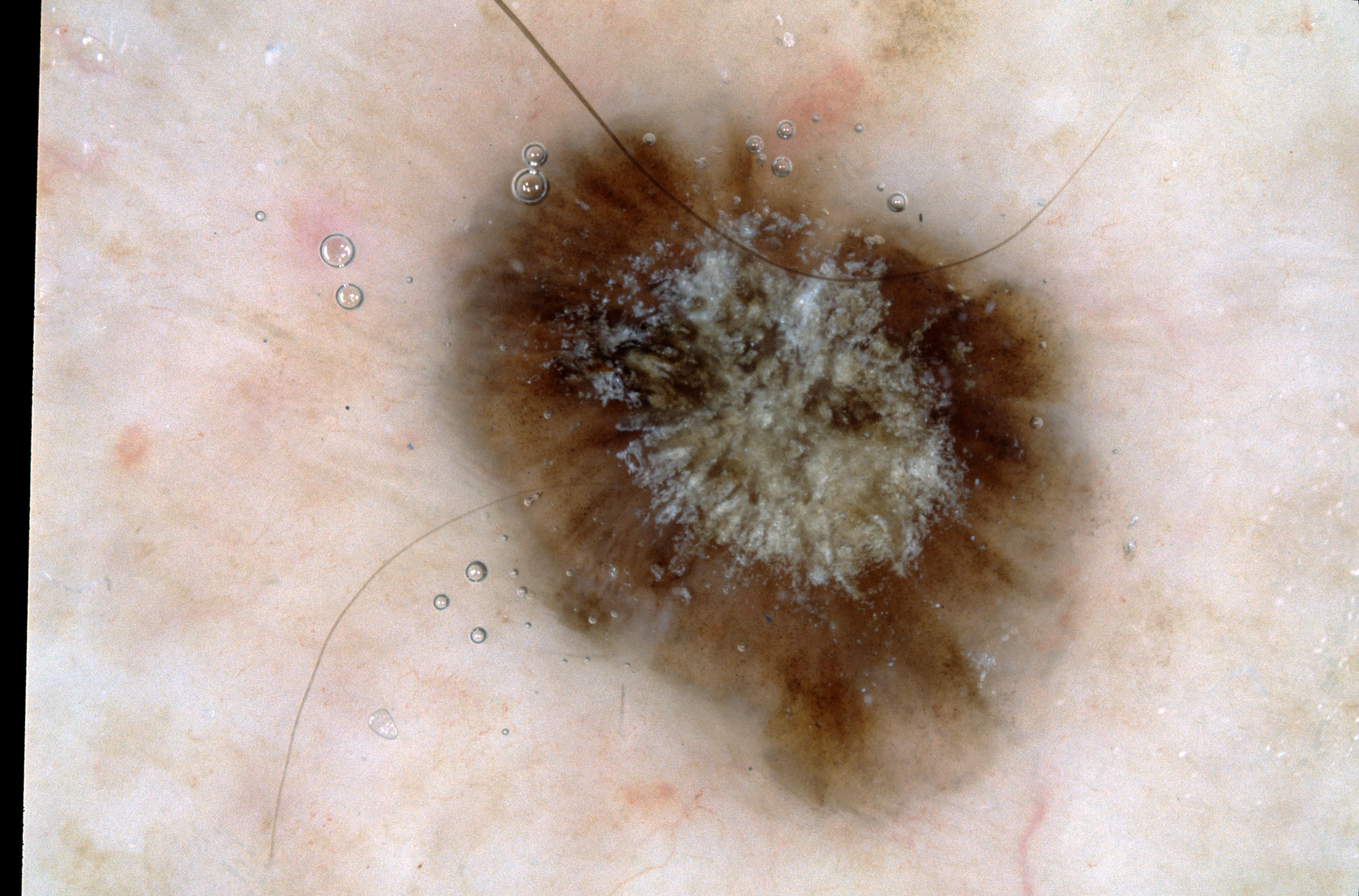 Skin Cancer Object Detection Dataset by Tirths Work