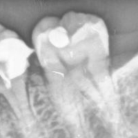 Tooth Segmentation Object Detection Model by gabriels
