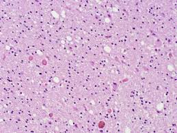 astrocytoma grading Classification Model by Charisse Estocado