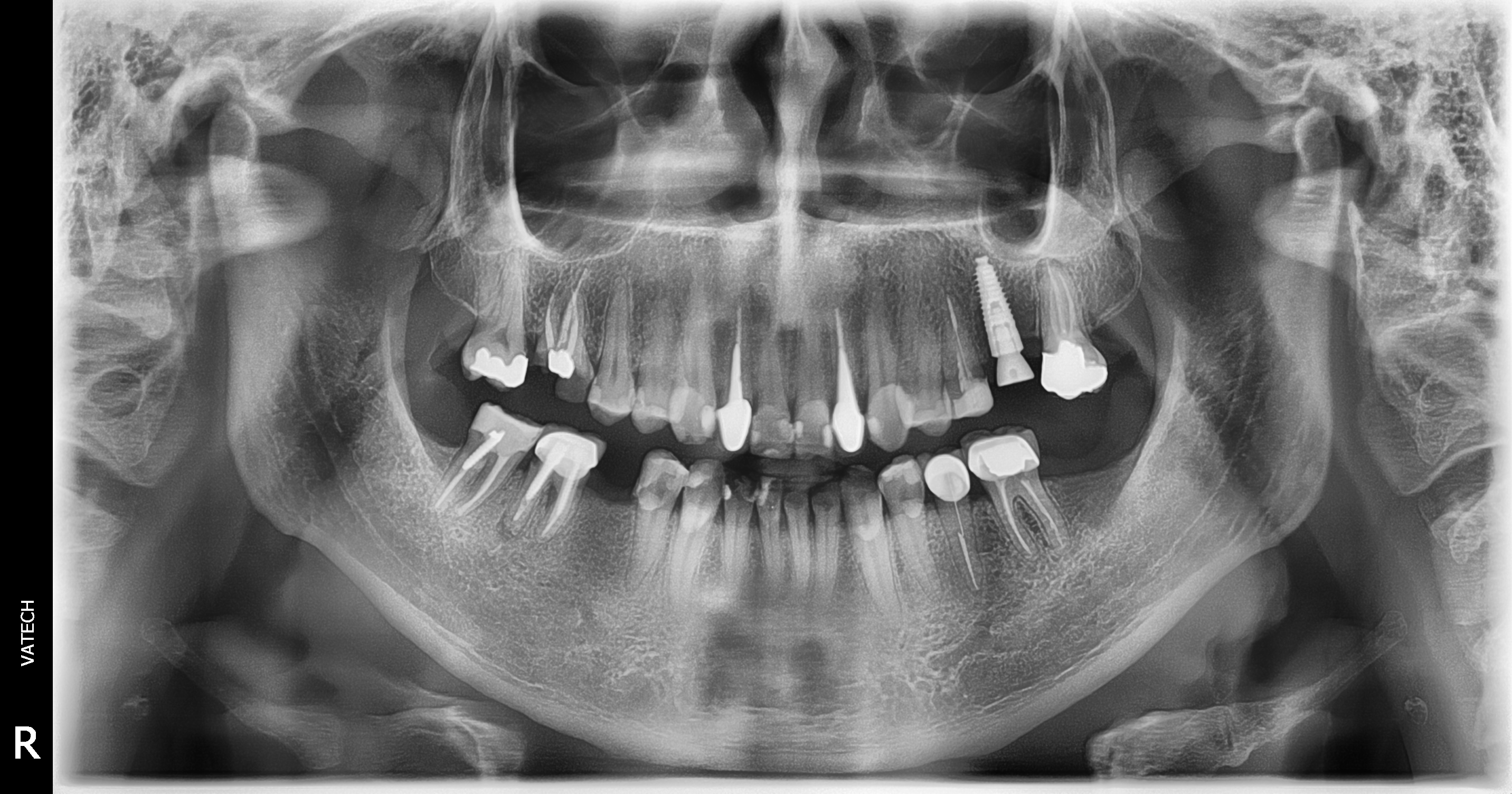 dental Instance Segmentation Dataset and Pre-Trained Model by lamp