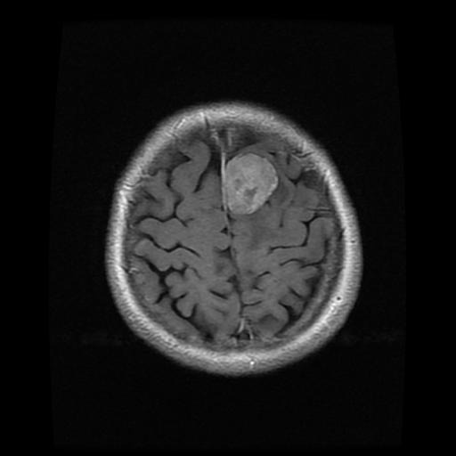 neuro-scan Instance Segmentation Model by Agha Hanzalah Ahmed