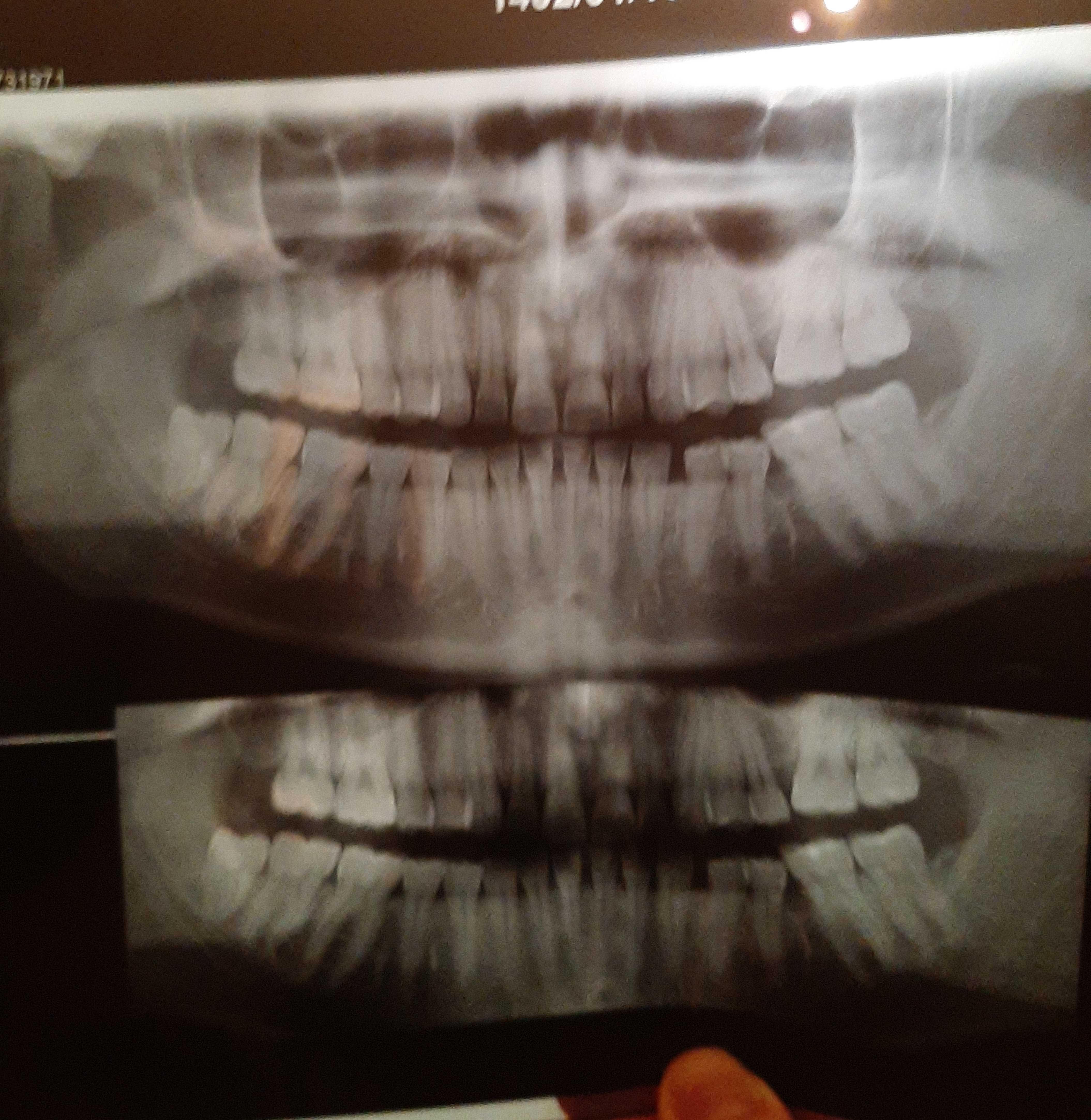 How To Use The Tooth Numbering Object Detection Api