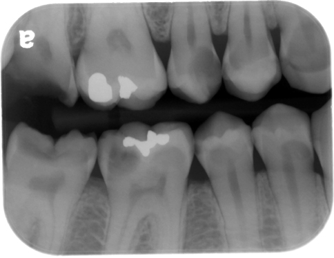 Caries Dentaires Object Detection Dataset and Pre-Trained Model by shreku
