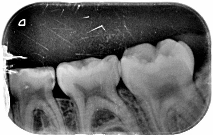 Dental Xray Dataset Object Detection Dataset By Shreku