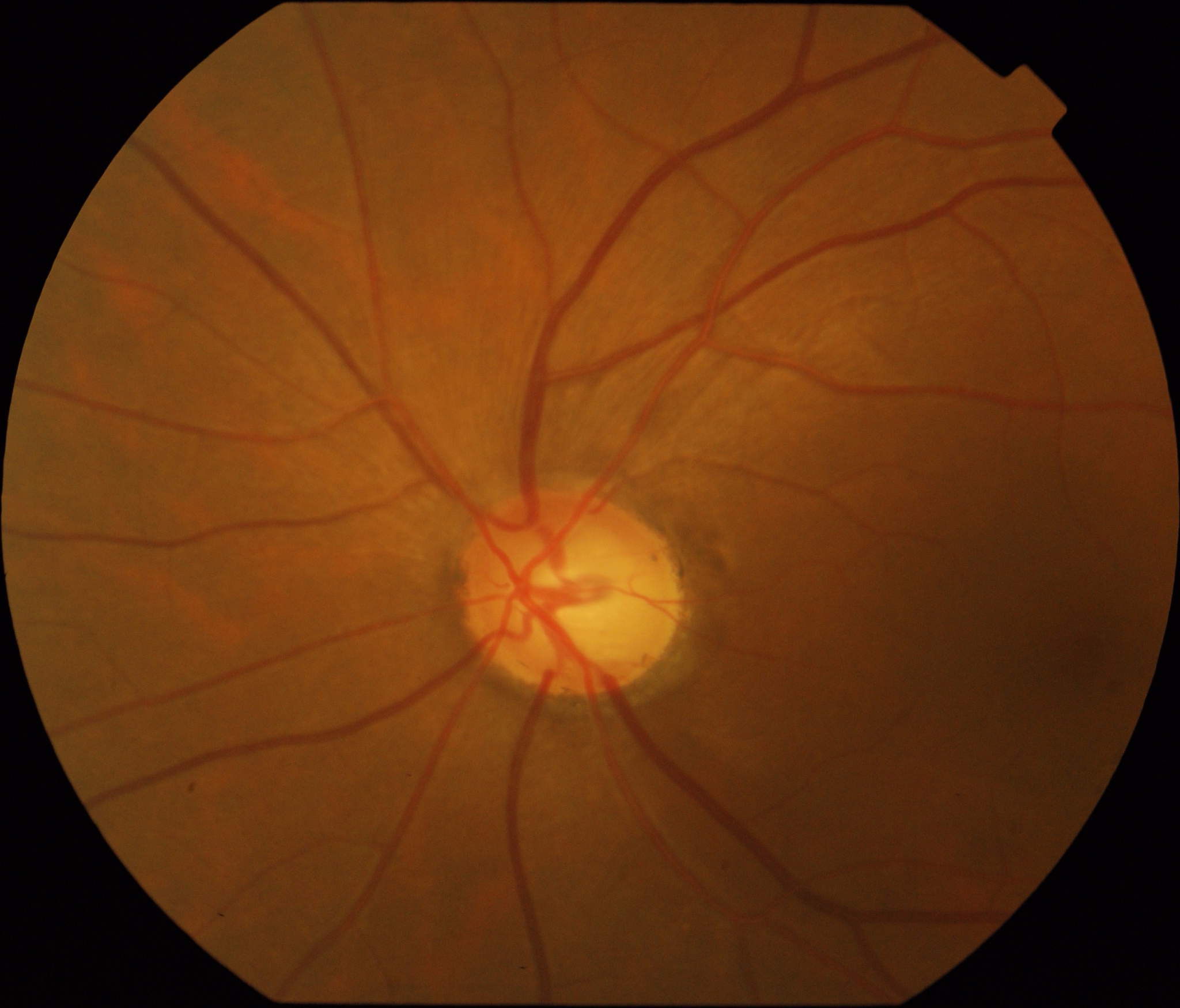 glaucoma Object Detection Dataset by Samsun University