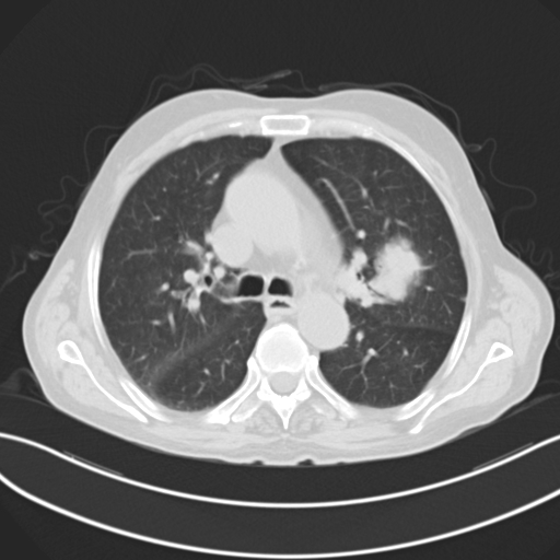 Lungctscan Object Detection Dataset By Braincancer