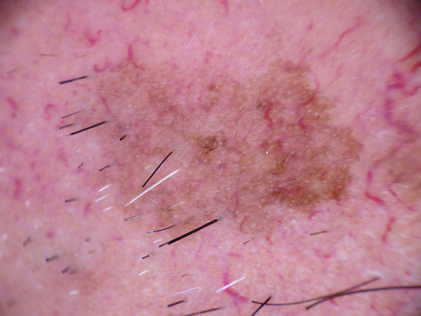 Skin Cancer dataset Classification Dataset by DL project