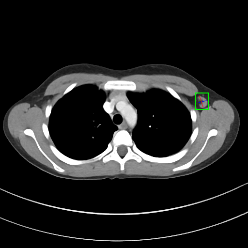 Lung Cancer Object Detection Dataset And Pre Trained Model By Ilk Deneme