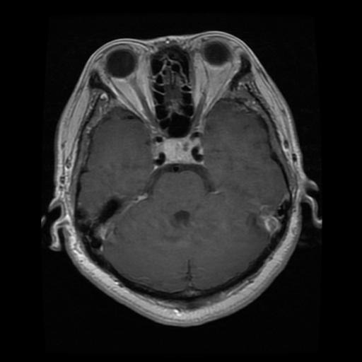 FYDP-BTD Object Detection Model by FYDP