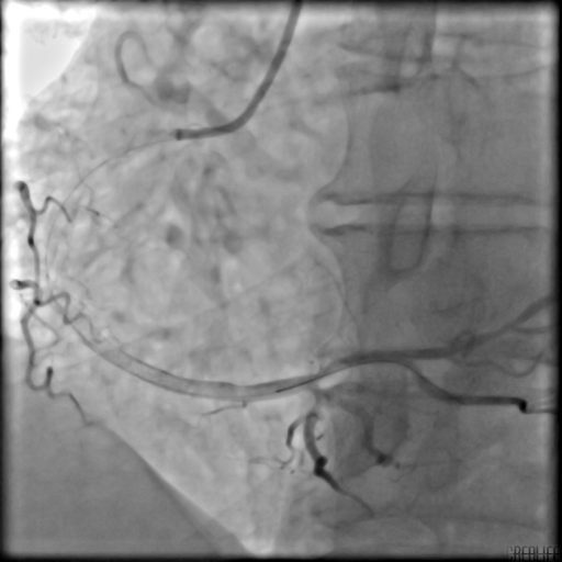 Guidewire Detection Object Detection Model By Guidewire